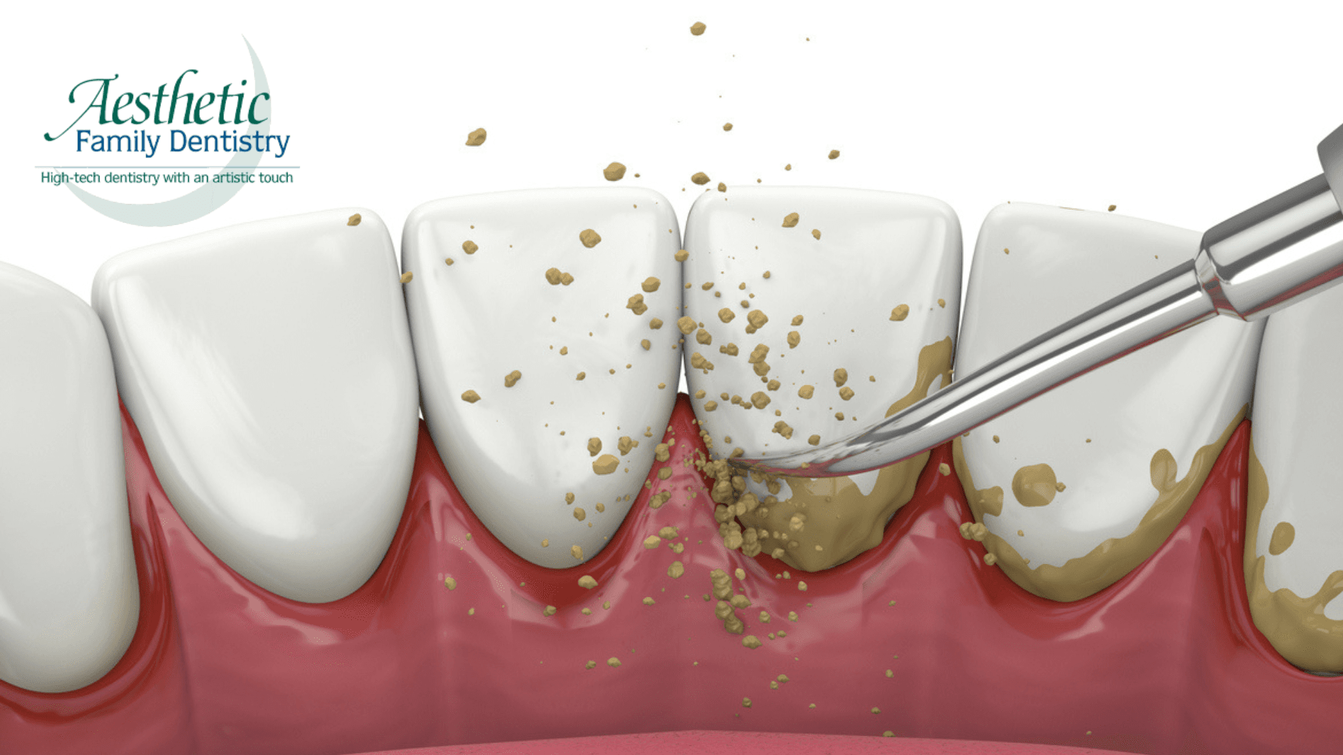 What Is Plaque and How Can It Harm My Teeth?