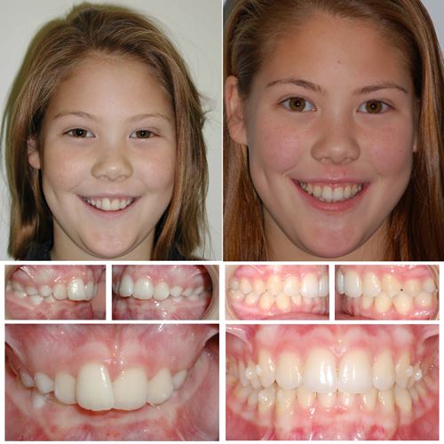 Invisalign Before & After